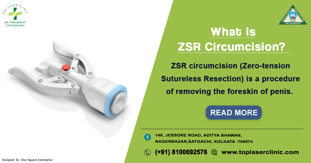 ZSR Circumcision: A Painless Process