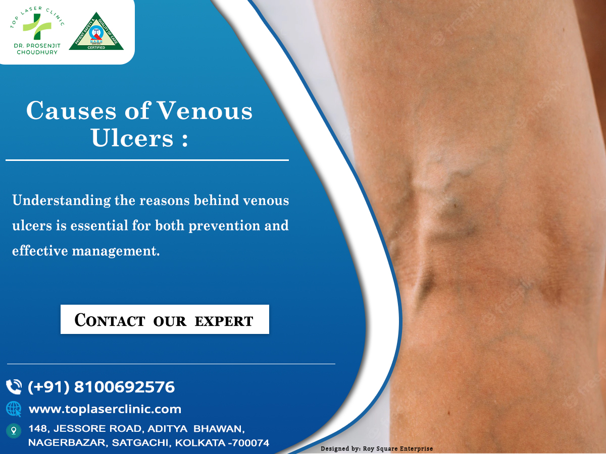 Venous Ulcers: Causes, Symptoms & Treatments